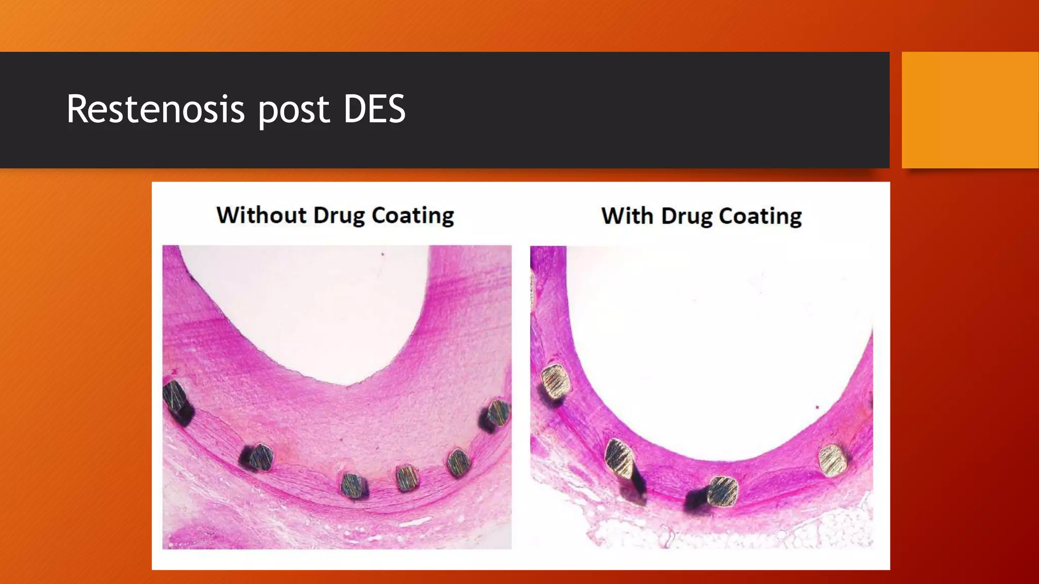 DRUG ELUTING BALLOONS (DCB/DEB) | PPTX