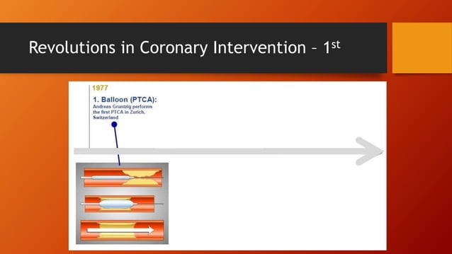 DRUG ELUTING BALLOONS (DCB/DEB) | PPTX