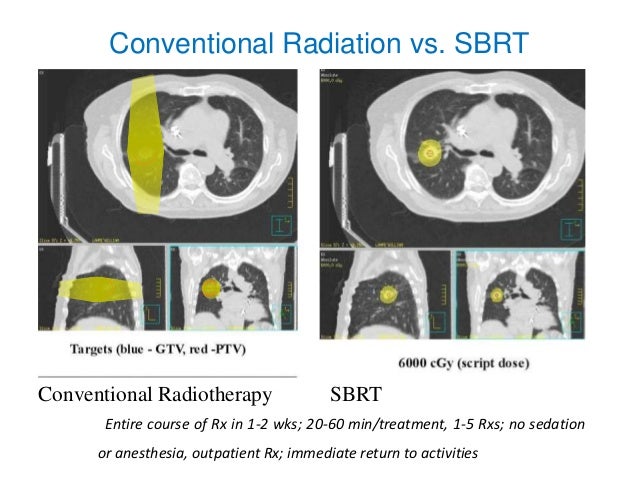 SBRT versus Surgery in Early lung cancer : Debate