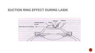 Debate lattice degenertion to laser OR NOT-AJAY DUDANI | PPTX