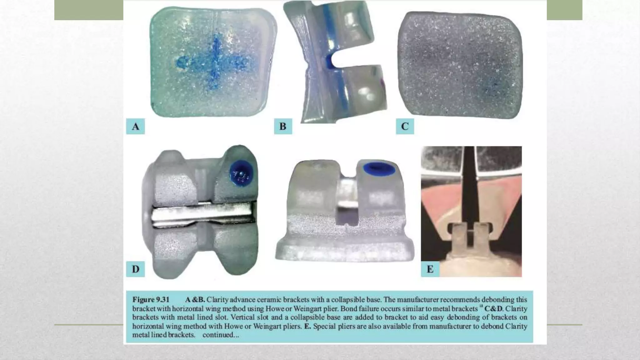 Debonding of orhtodontic brackets | PPTX