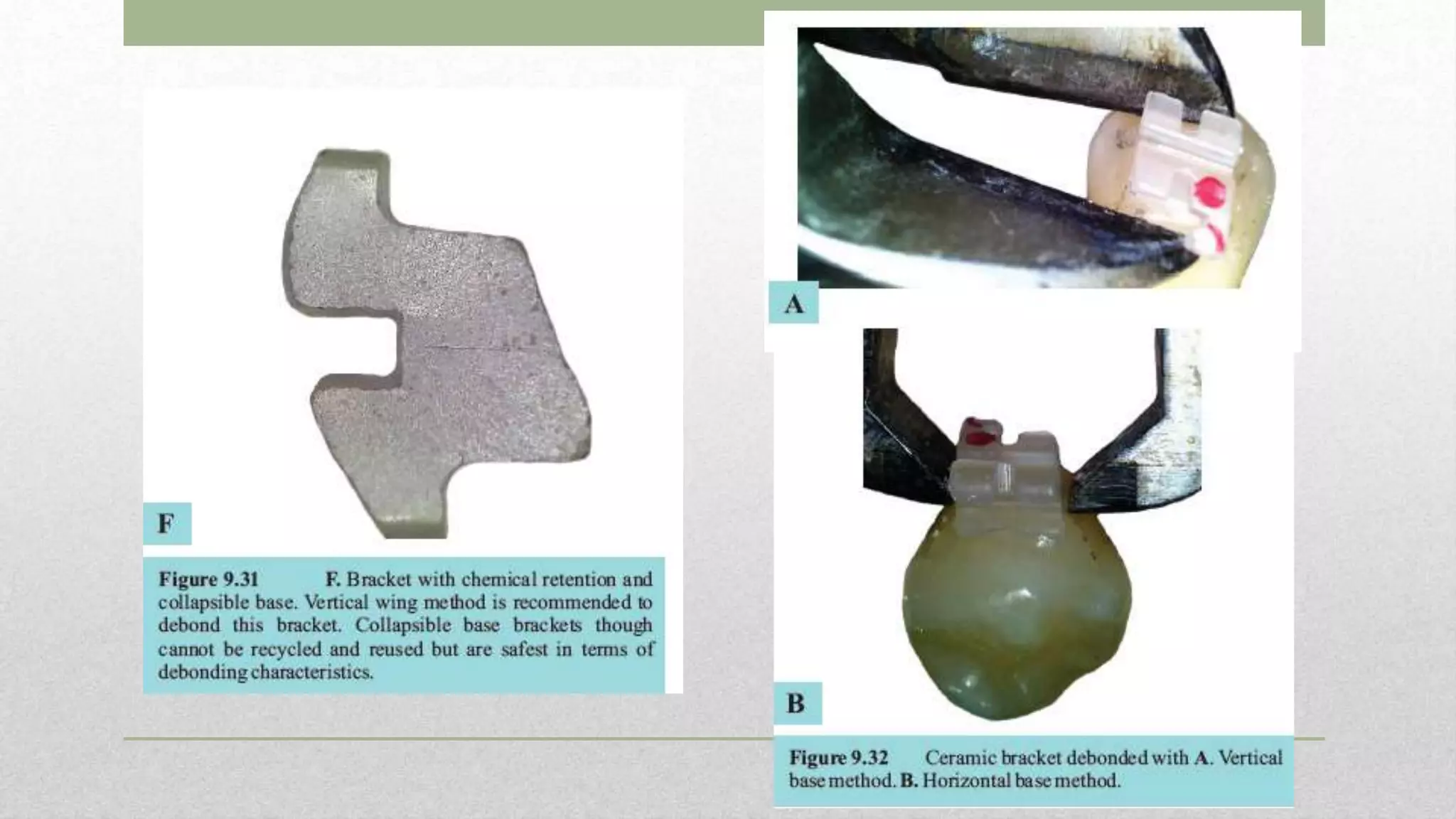 Debonding of orhtodontic brackets | PPTX
