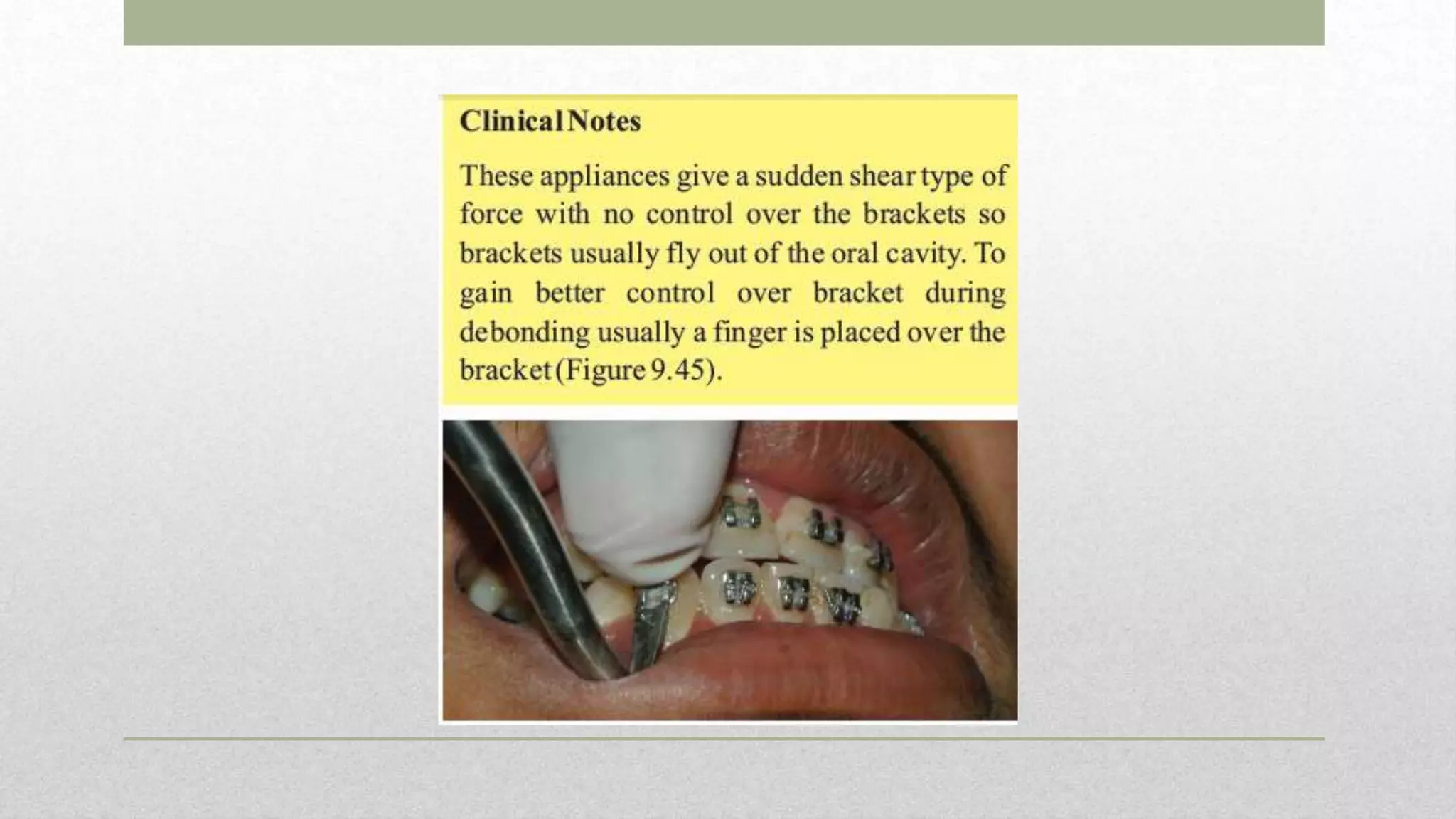 Debonding of orhtodontic brackets | PPTX
