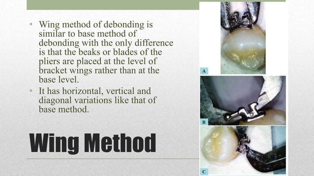 Debonding of orhtodontic brackets | PPTX | Dental Health | Diseases and ...