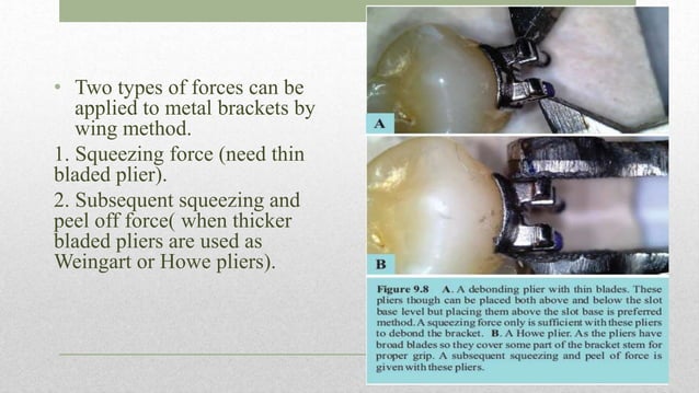 Debonding of orhtodontic brackets | PPTX | Dental Health | Diseases and ...