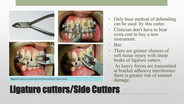 Debonding of orhtodontic brackets | PPTX | Dental Health | Diseases and ...