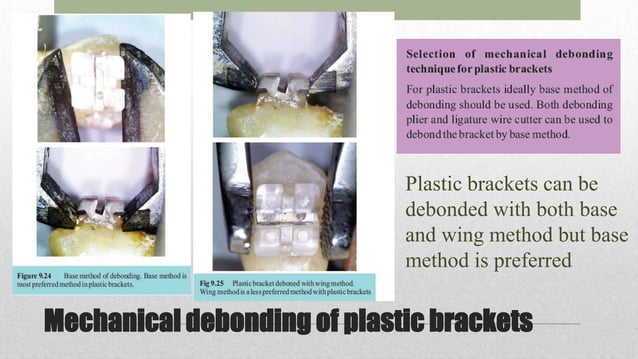 Debonding of orhtodontic brackets | PPTX | Dental Health | Diseases and ...