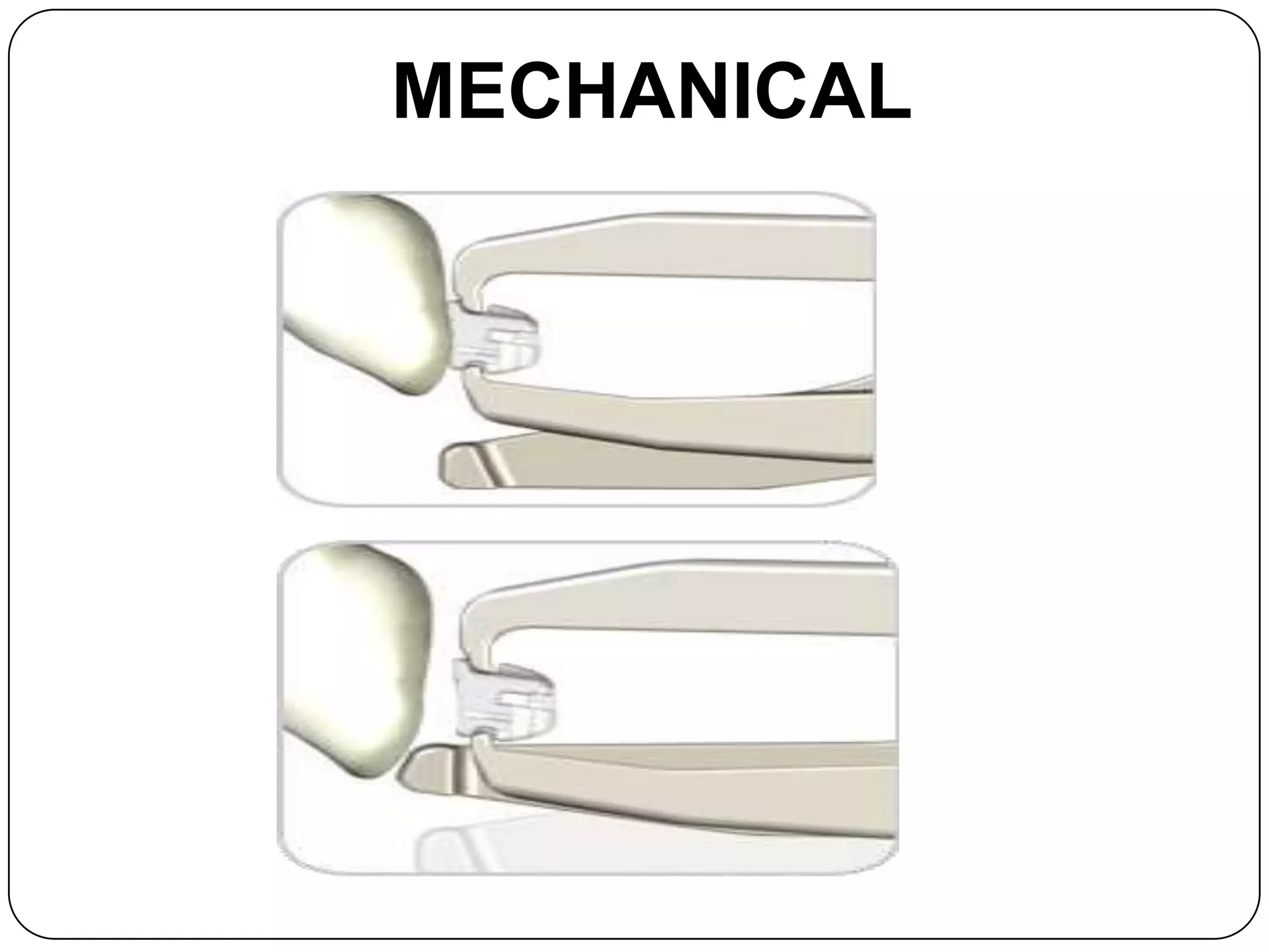 Debonding procedures in orthodontics | PPTX