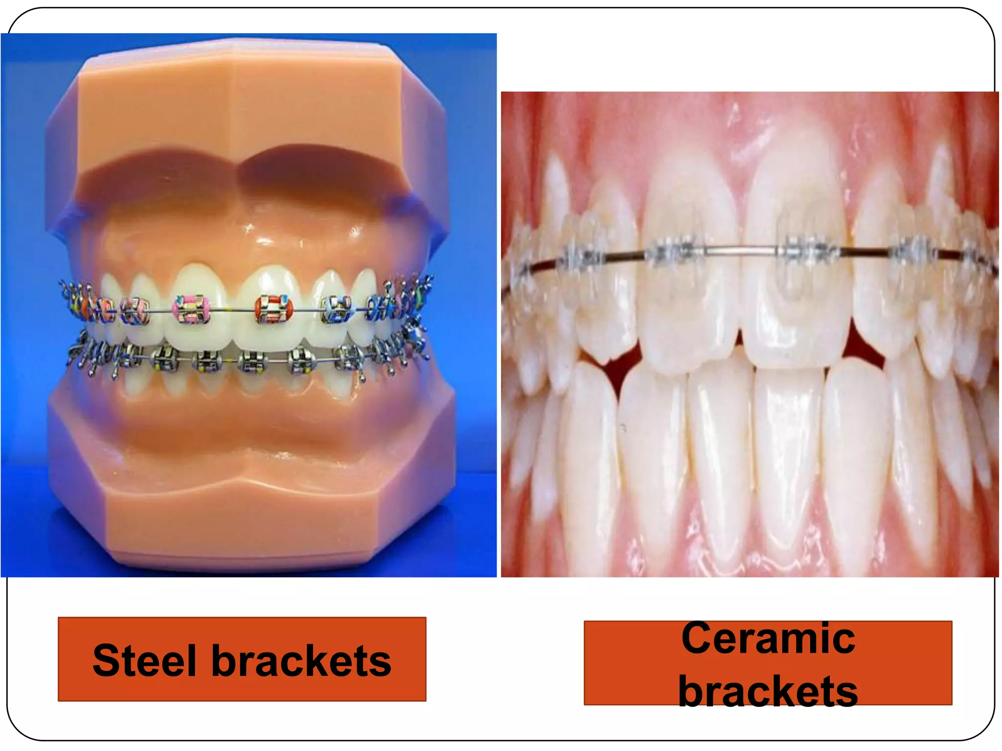 Debonding procedures in orthodontics | PPTX