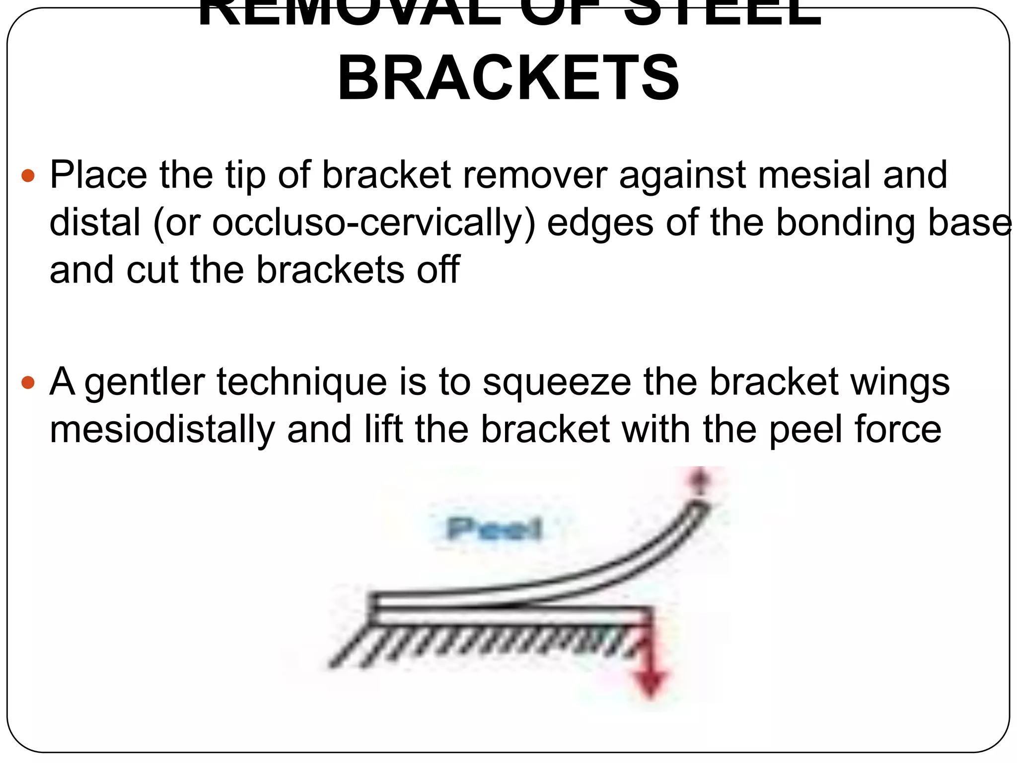 Debonding procedures in orthodontics | PPTX