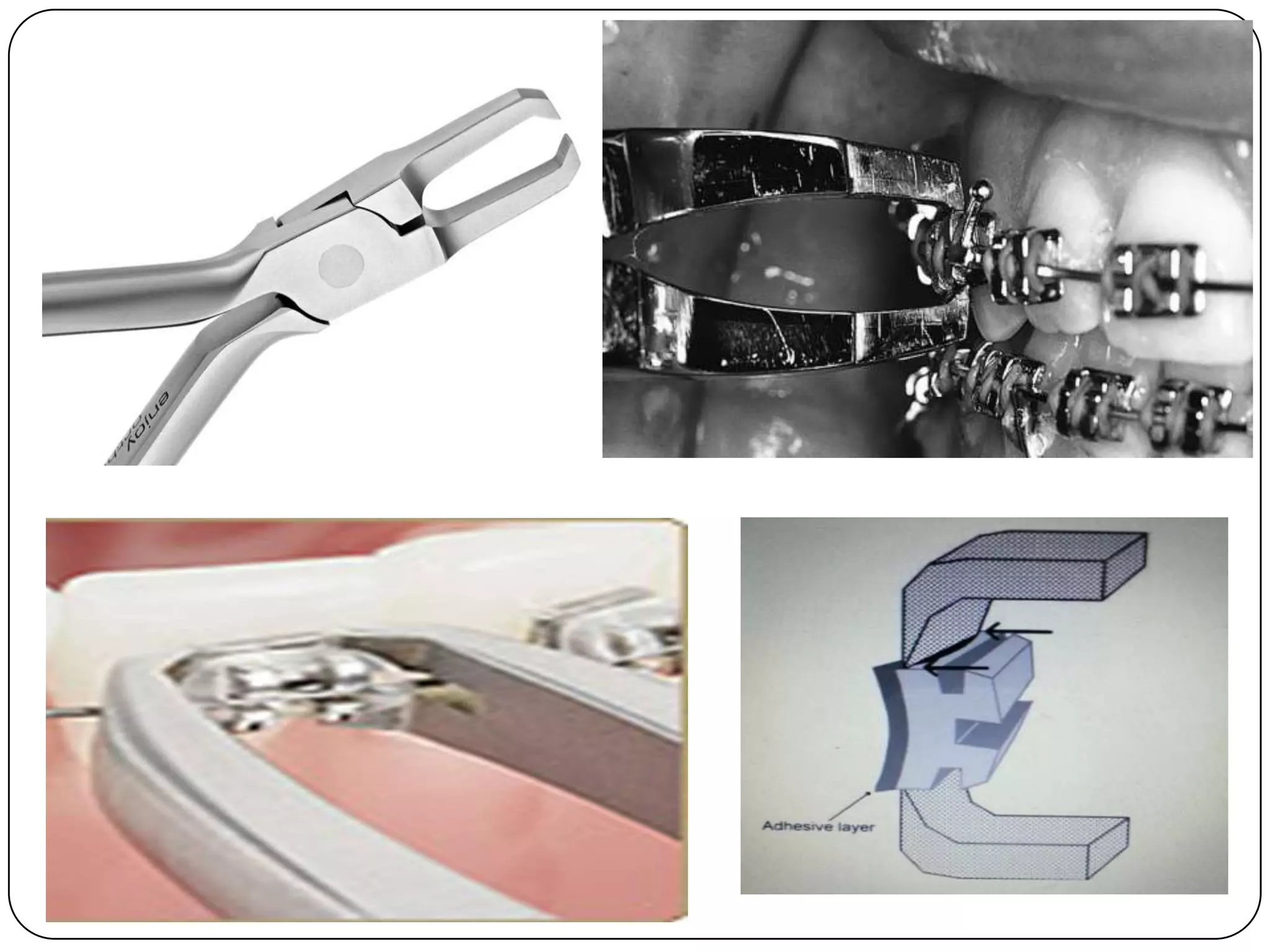 Debonding procedures in orthodontics | PPTX