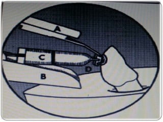 Debonding procedures in orthodontics | PPTX