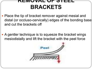 Debonding procedures in orthodontics | PPTX