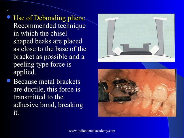 Debonding techniques and enamel fracture patterns /certified fixed ...