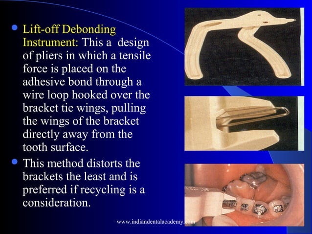 Debonding techniques and enamel fracture patterns /certified fixed ...