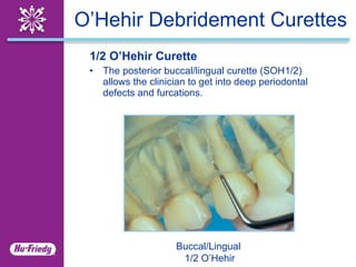 Debridement Curettes | PPT