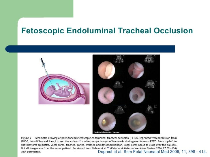 Anaesthesia for foetal surgery