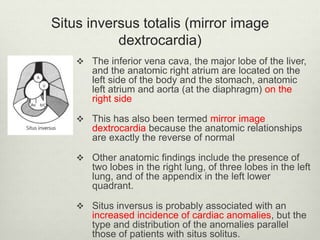 Dextrocardia | PPTX