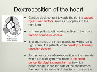 Dextrocardia | PPTX
