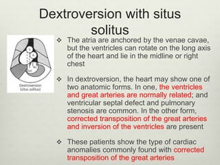 Dextrocardia | PPT