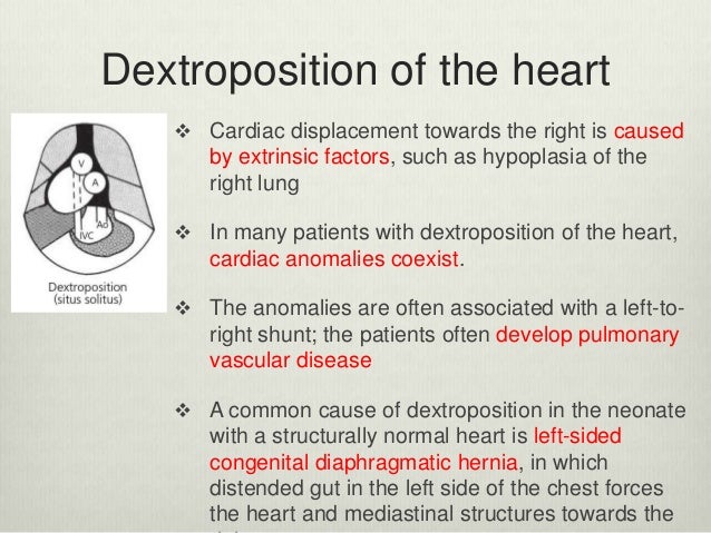 Dextrocardia