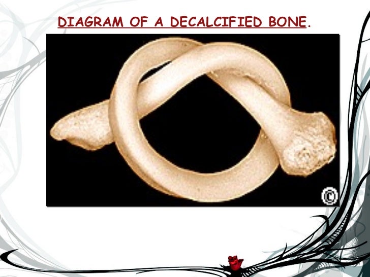 Decalcification of bone