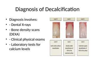 decalcification_presentation Health medicine.pptx