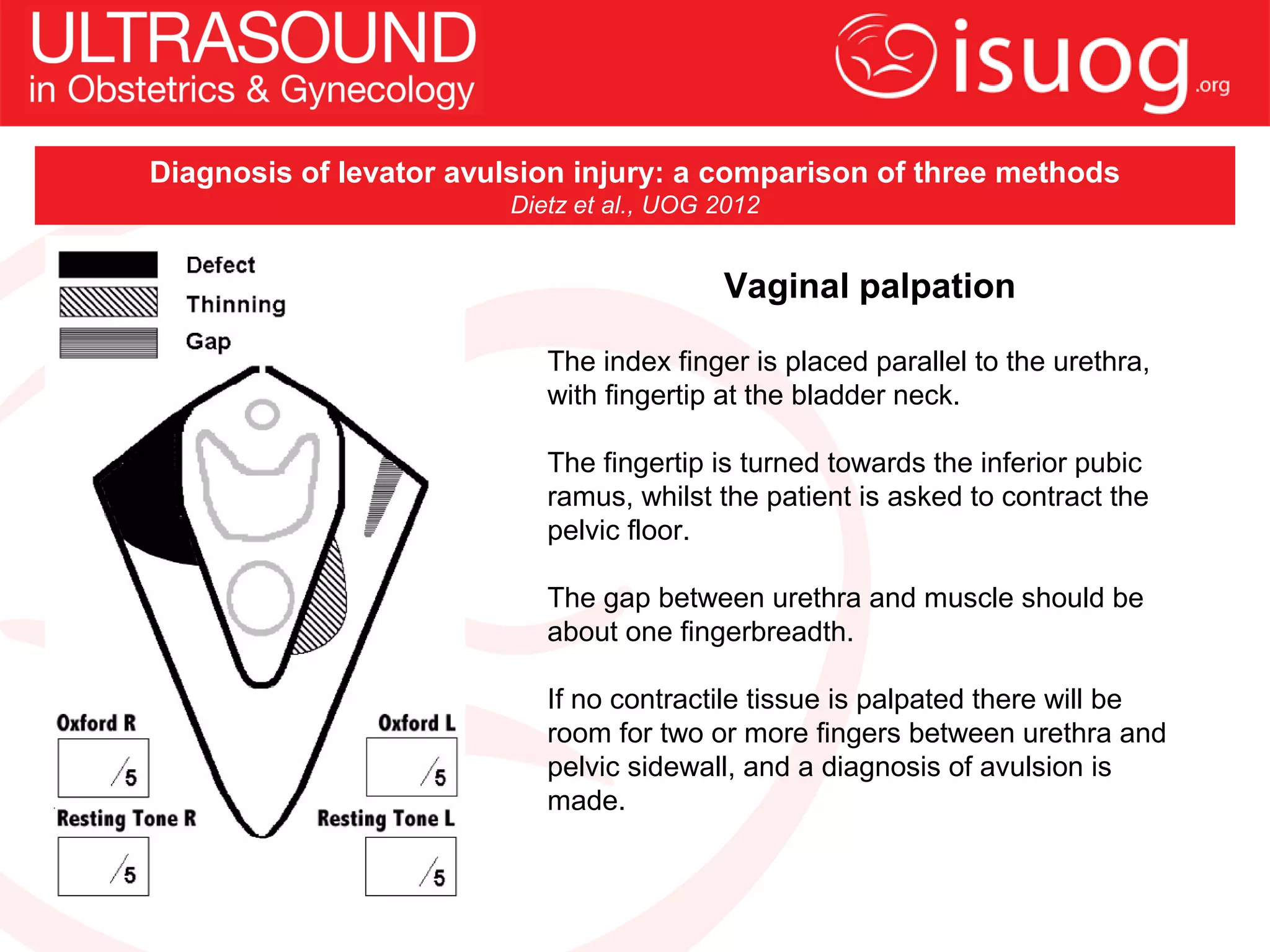 UOG Journal Club: Diagnosis of levator avulsion injury: a comparison of ...