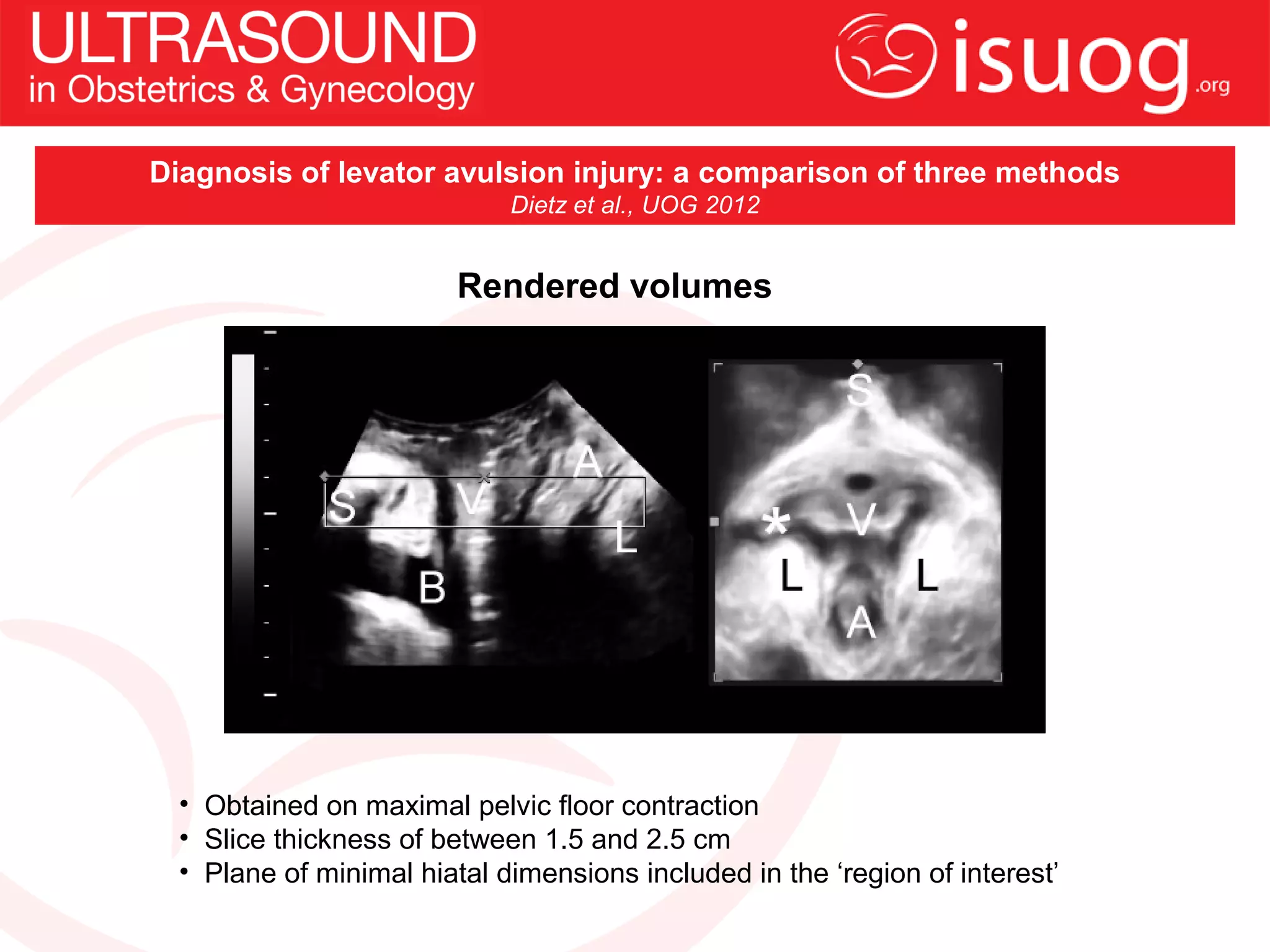 UOG Journal Club: Diagnosis of levator avulsion injury: a comparison of ...