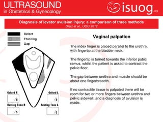 UOG Journal Club: Diagnosis of levator avulsion injury: a comparison of ...