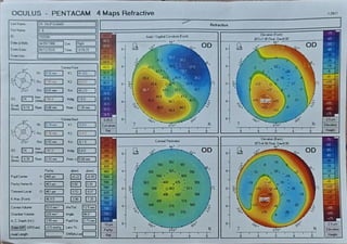 Corneal topography in detailed explation | PPT
