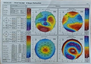 Corneal topography in detailed explation | PDF