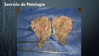 Deciduitis aguda en mujer menopáusica. Presentación de un caso | PDF