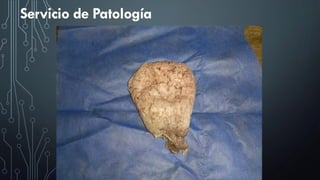 Deciduitis aguda en mujer menopáusica. Presentación de un caso | PDF