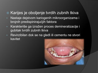 Karijes kod dece | PPTX