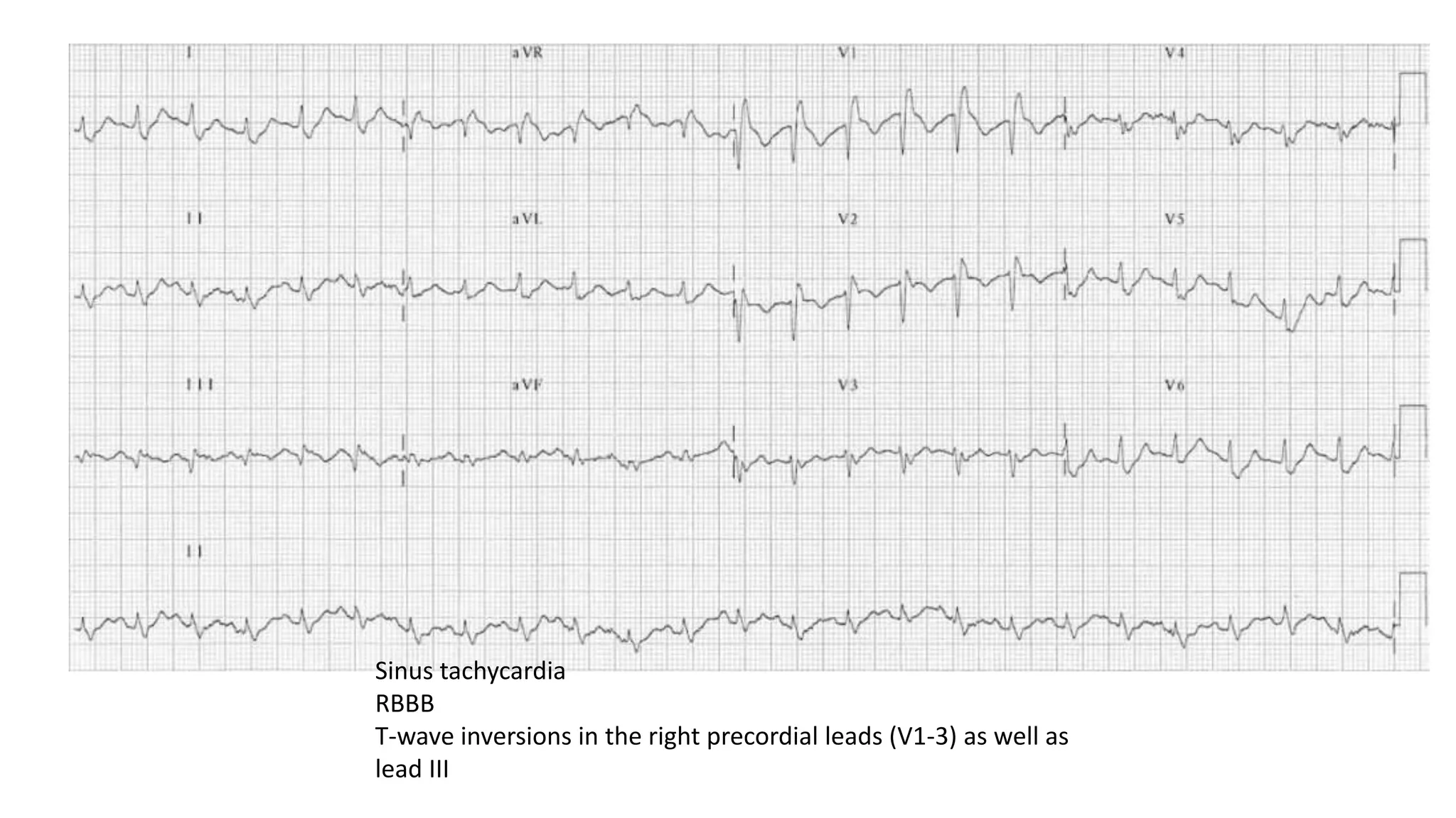 DECIPHERING COMMON ECG FINDINGS IN ED.pptx