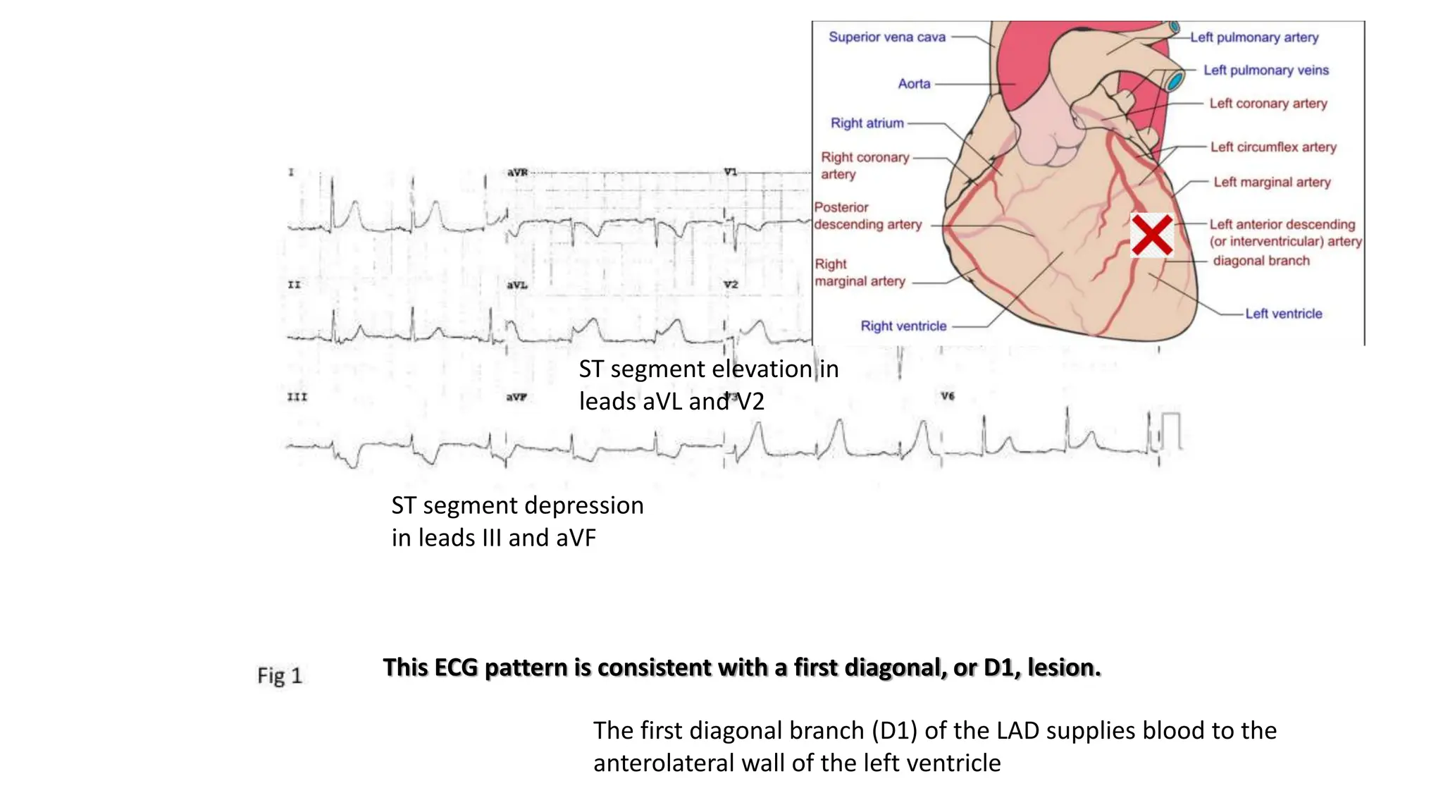 DECIPHERING COMMON ECG FINDINGS IN ED.pptx