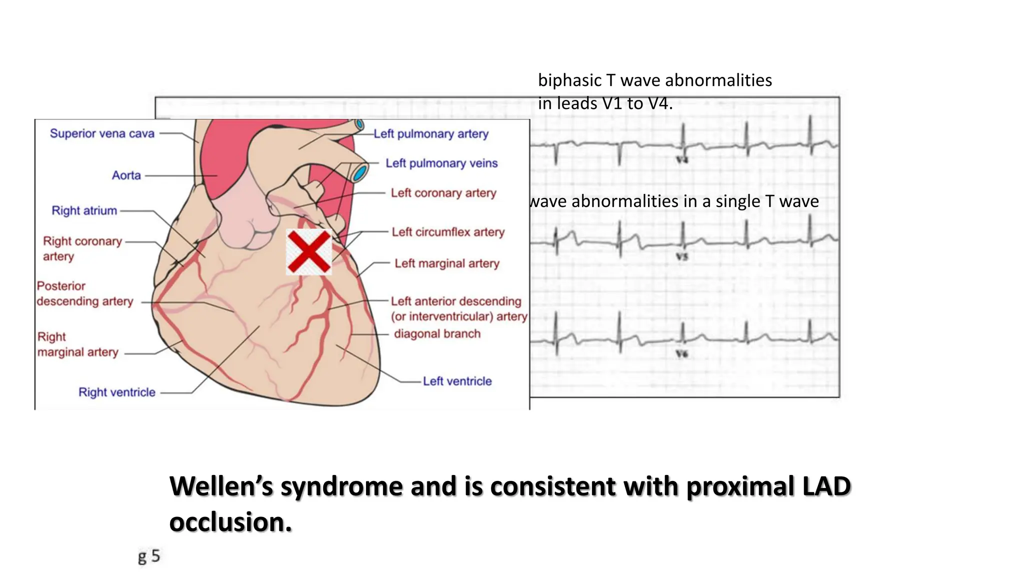 DECIPHERING COMMON ECG FINDINGS IN ED.pptx