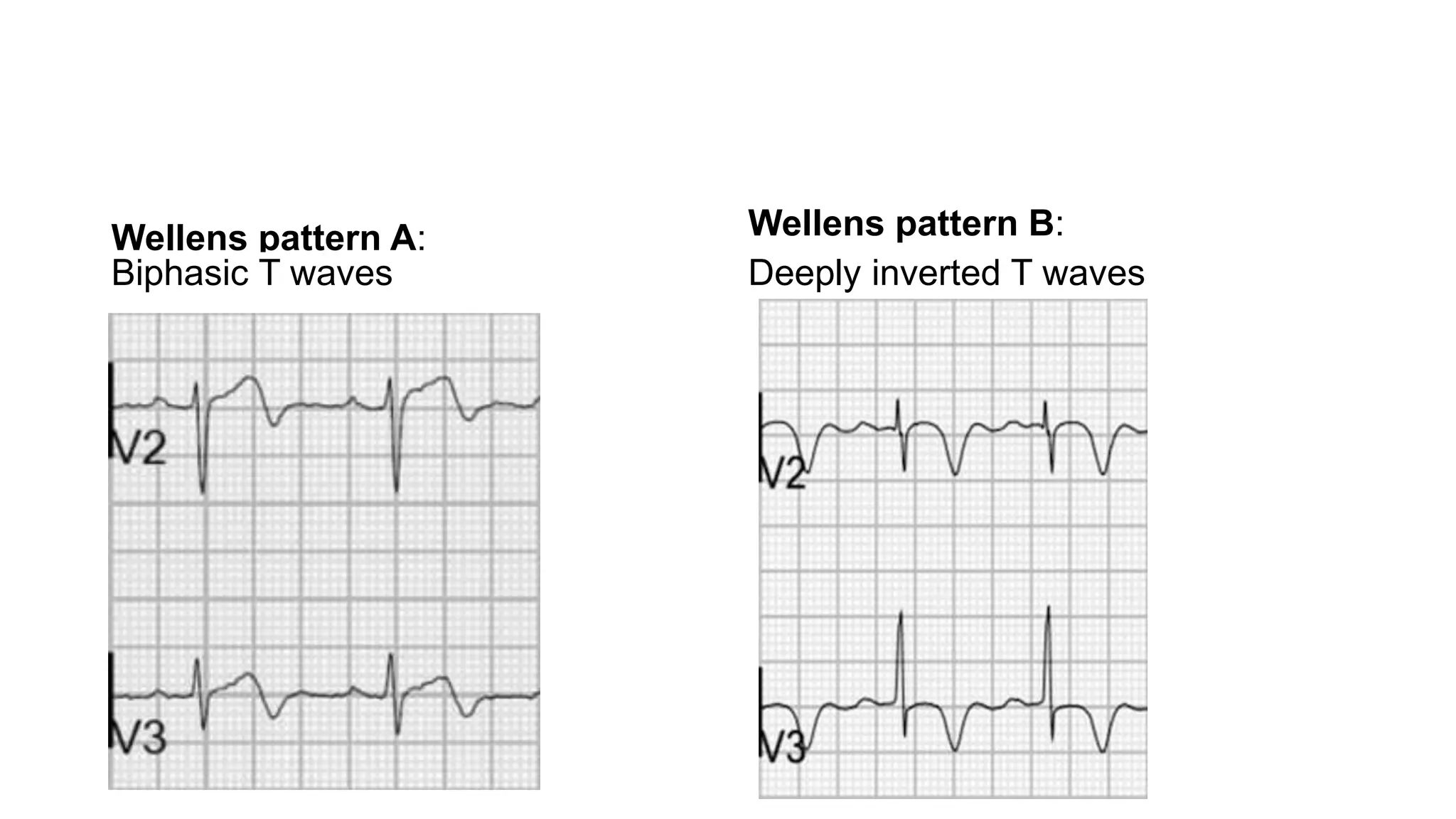 DECIPHERING COMMON ECG FINDINGS IN ED.pptx