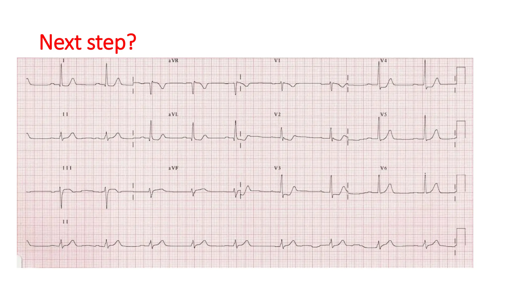 DECIPHERING COMMON ECG FINDINGS IN ED.pptx