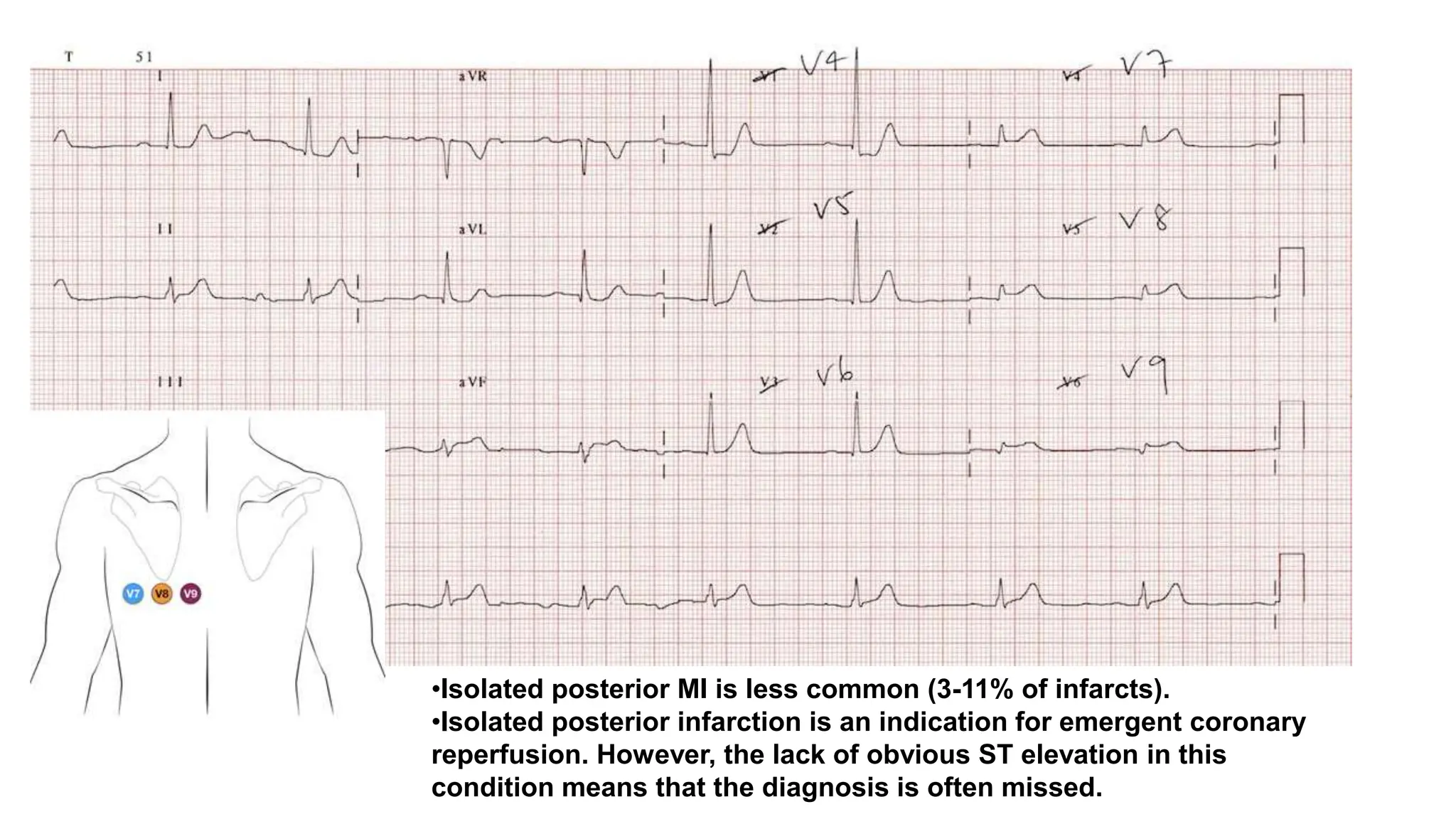 DECIPHERING COMMON ECG FINDINGS IN ED.pptx