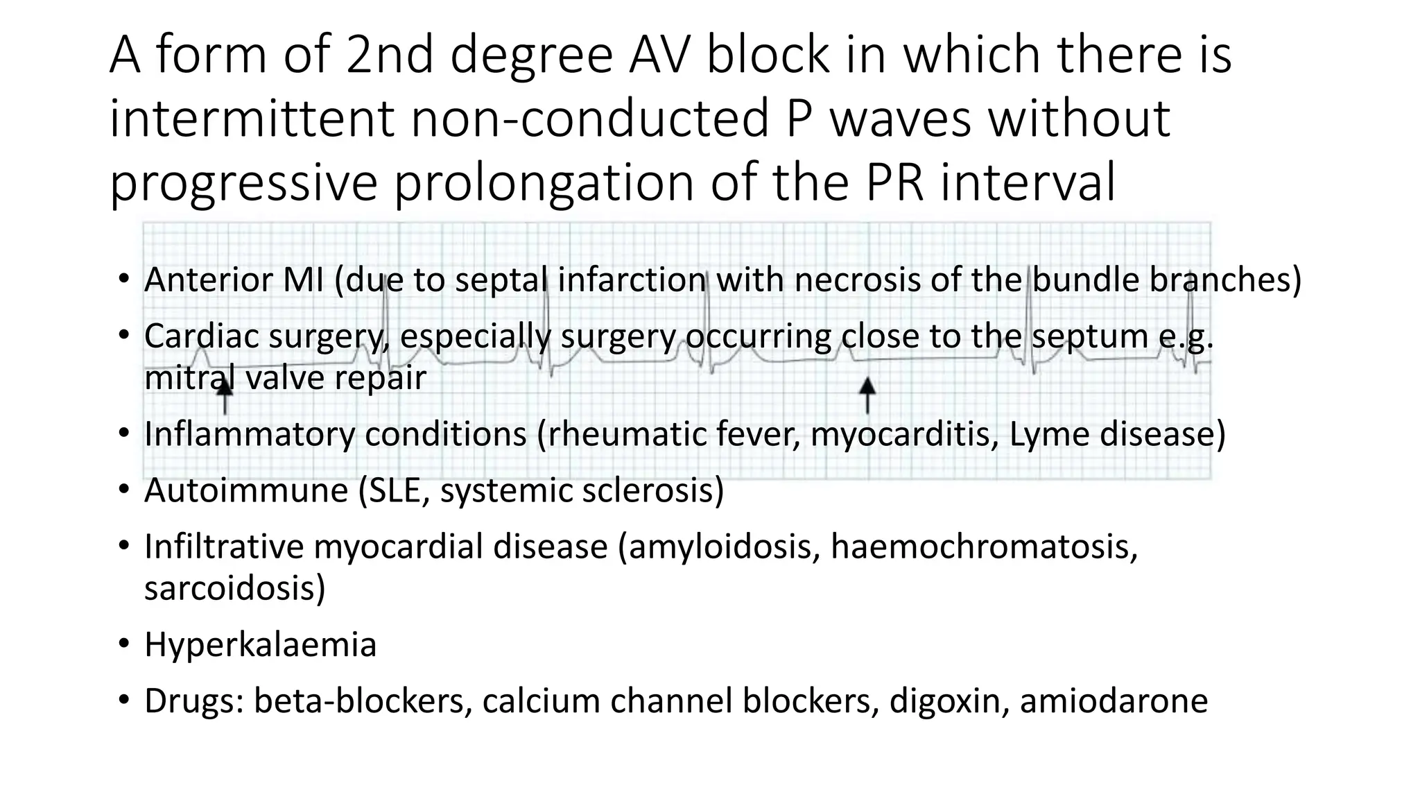 DECIPHERING COMMON ECG FINDINGS IN ED.pptx