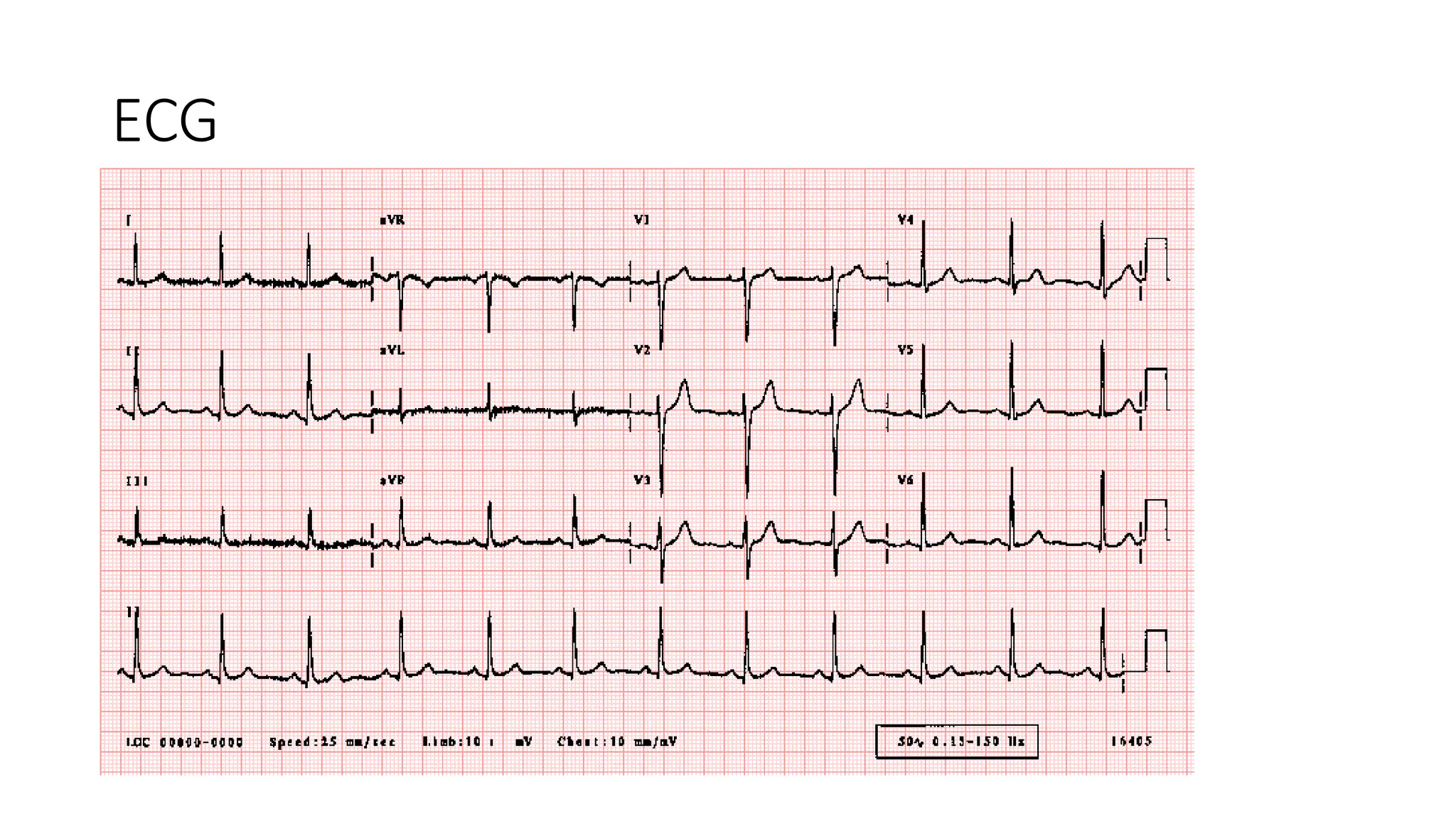DECIPHERING COMMON ECG FINDINGS IN ED.pptx