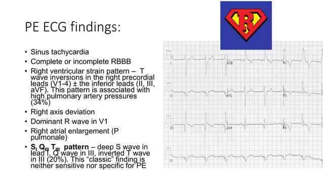 DECIPHERING COMMON ECG FINDINGS IN ED.pptx | Free Download