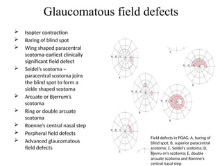 Decision making and management of primary open angle (1).pptx