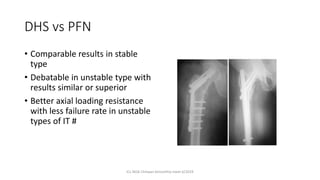 Decision making in fractures around hip icl 2019 chit | PPTX