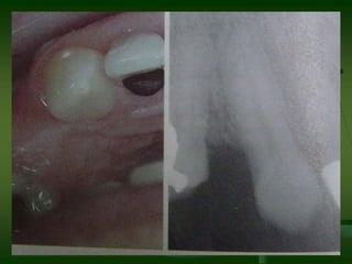 Decision making in implants.ppt