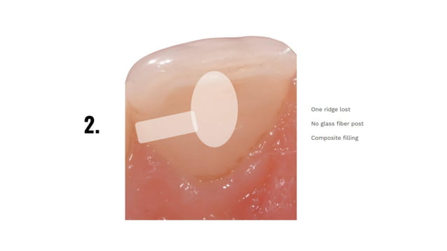 Decision Making in the Restoration of Endodontically Treated Teeth | PDF