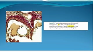 all about the Decompression sickness A to Z PPT | PPTX