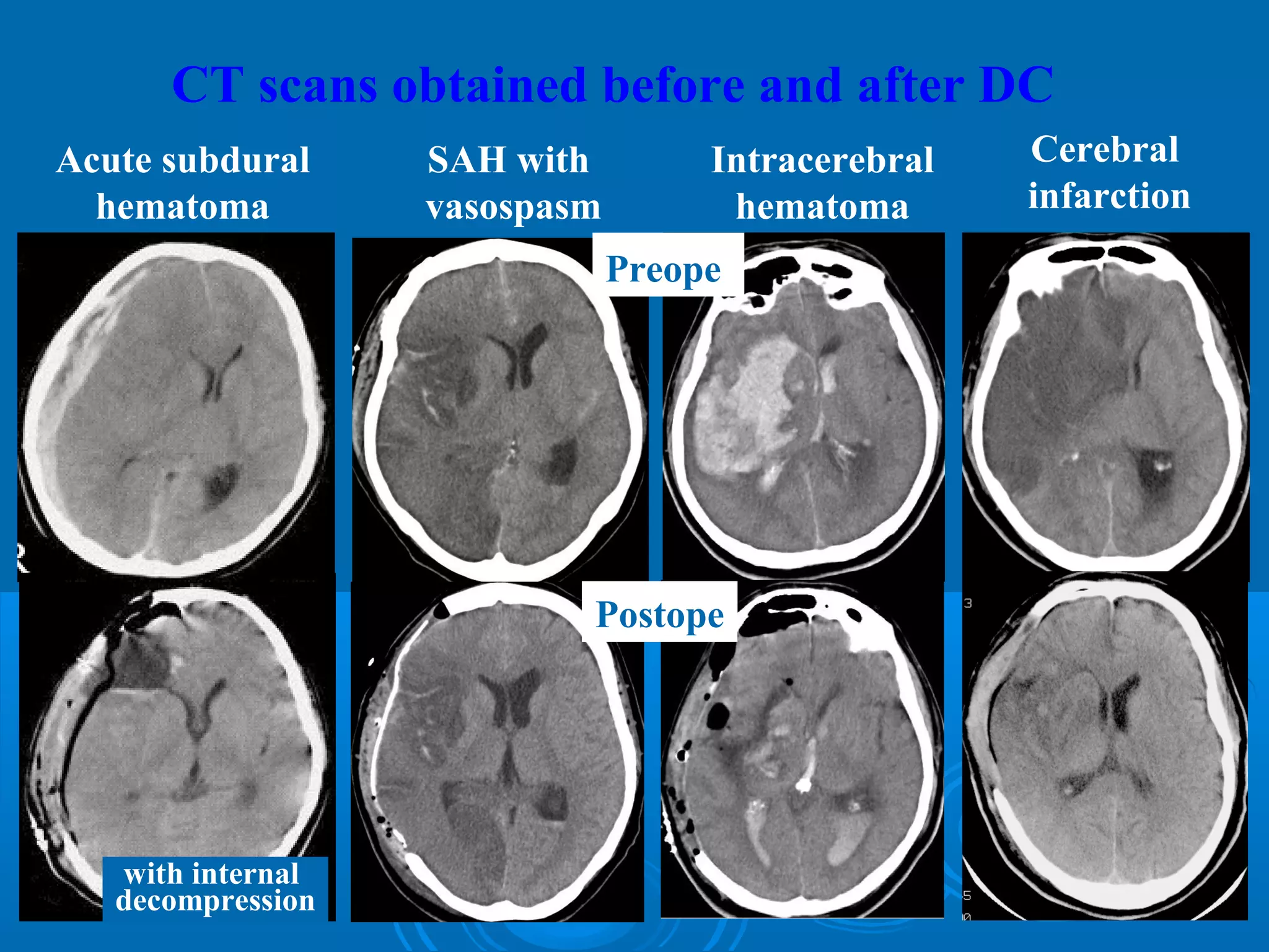 Decompressive craniectomy final | PPT